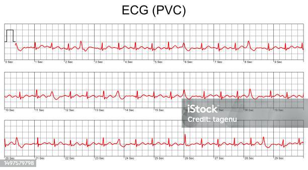 Ecg Cardiogramcardiac Arrhythmia Premature Ventricular Contraction ... Ecg Cardiogramcardiac Arrhythmia Premature Ventricular Contraction ...