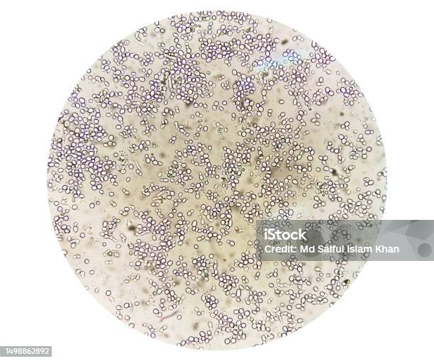 Sel Ragi Tunas Dalam Urin Pasien Pielonefritis Atau Sistitis Dianalisis Dengan Mikroskop Foto