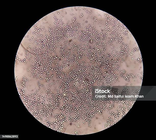 Sel Ragi Tunas Dalam Urin Pasien Pielonefritis Atau Sistitis Dianalisis Dengan Mikroskop Foto