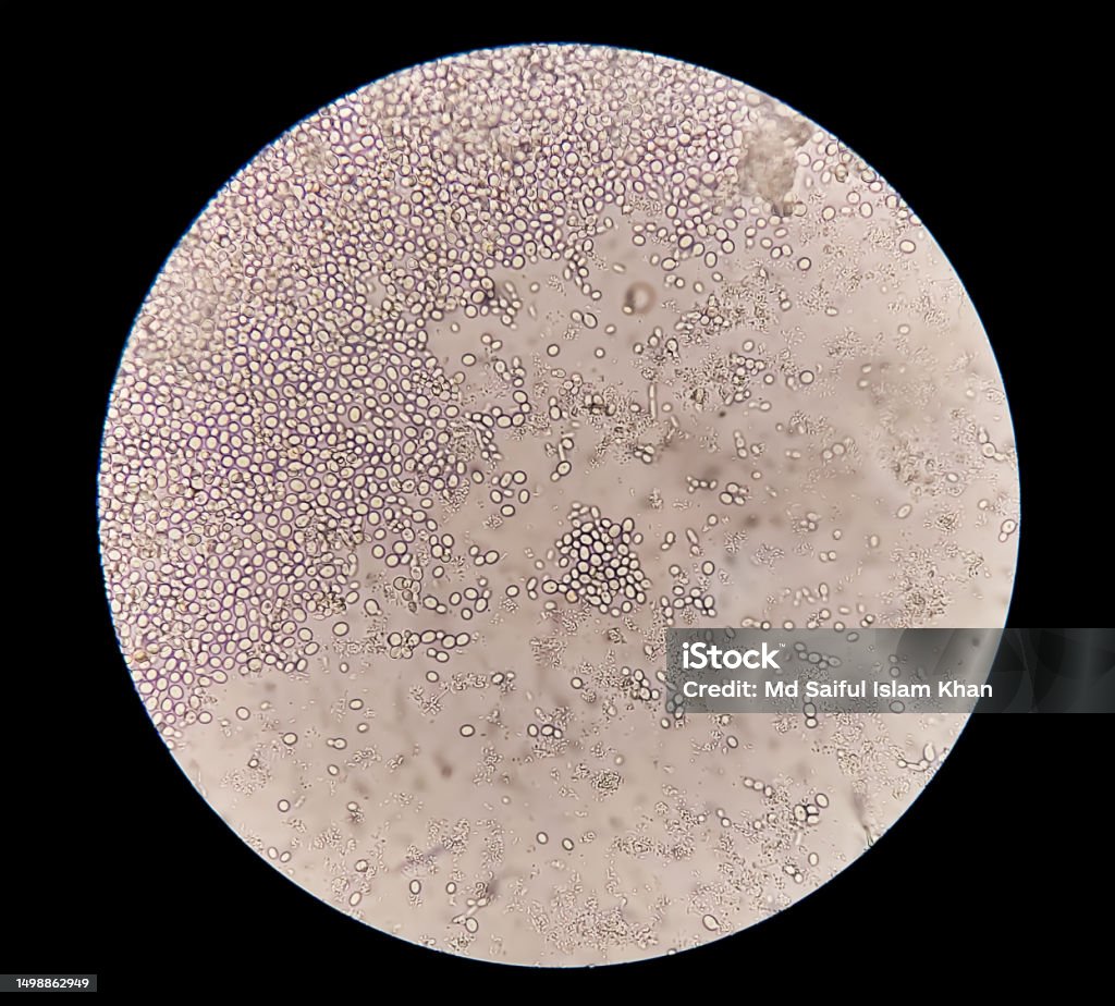 Sel Ragi Tunas Dalam Urin Pasien Pielonefritis Atau Sistitis Dianalisis