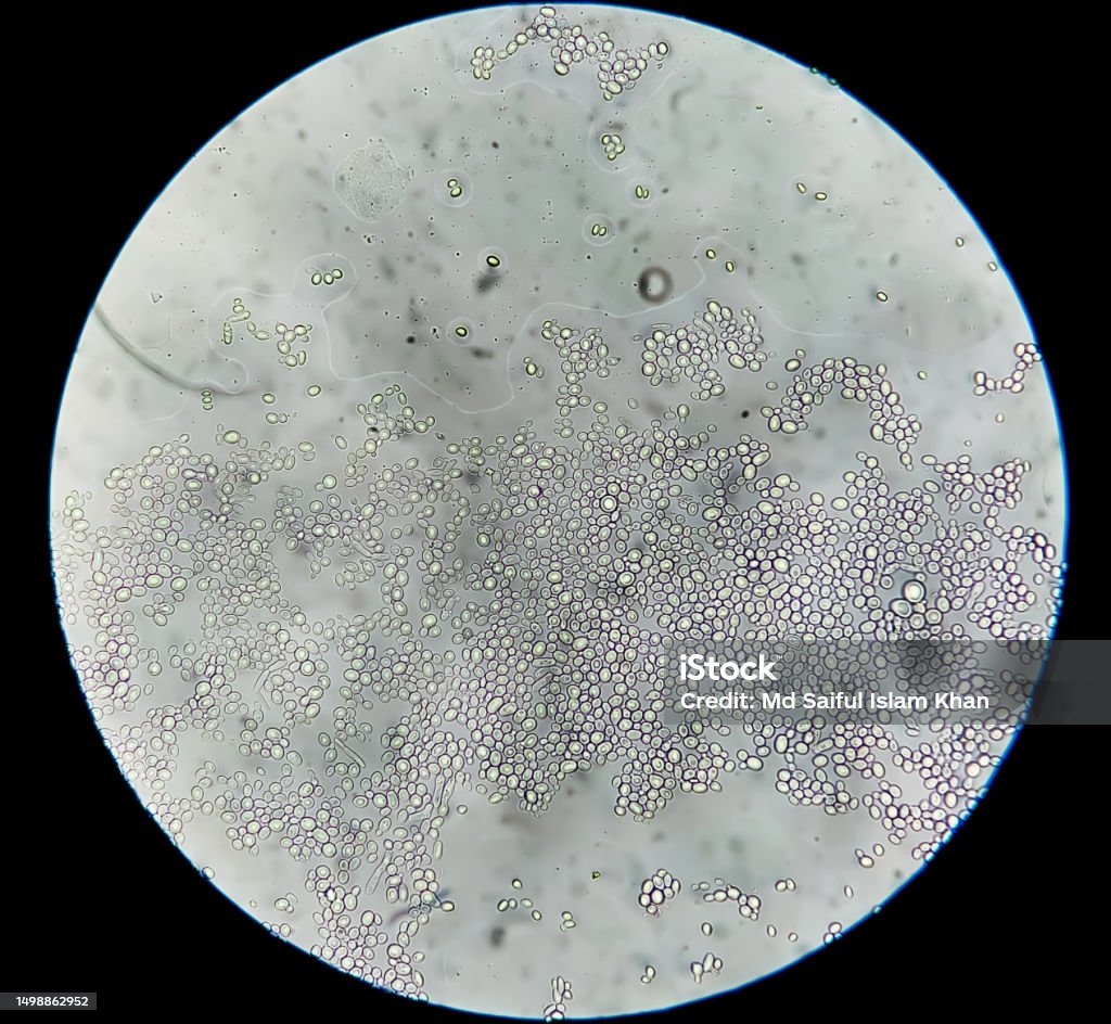 Sel Ragi Tunas Dalam Urin Pasien Pielonefritis Atau Sistitis Dianalisis Dengan Mikroskop Foto
