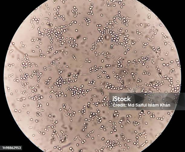 Sel Ragi Tunas Dalam Urin Pasien Pielonefritis Atau Sistitis Dianalisis Dengan Mikroskop Foto