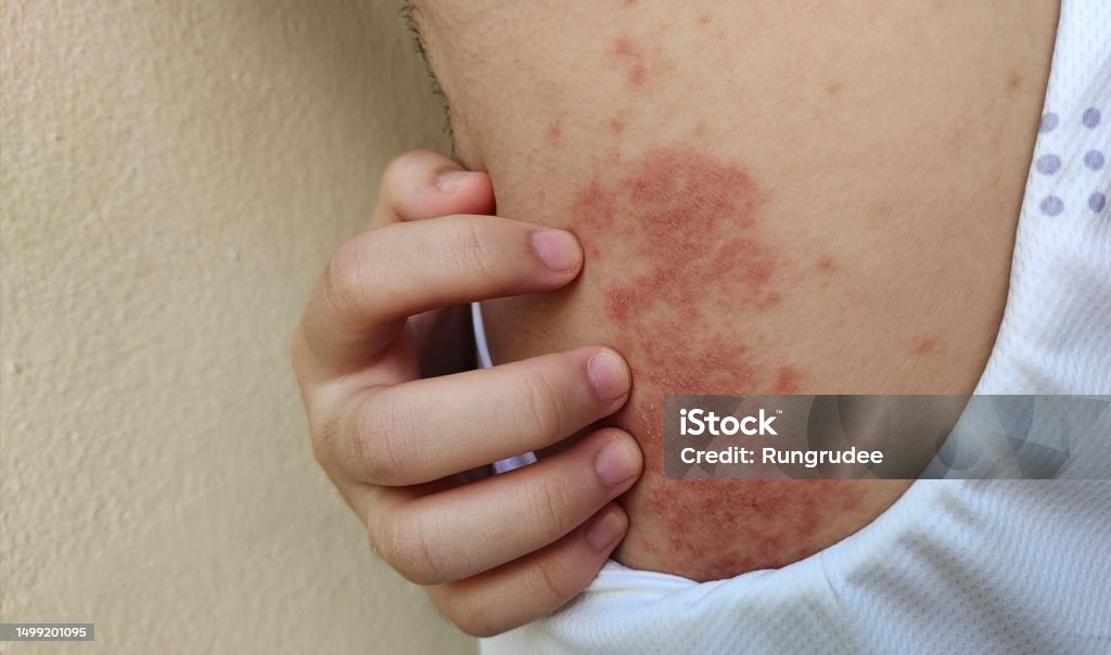 The Chronic Dermatitis Rash Hives Itchy Pustules On The Back Stock