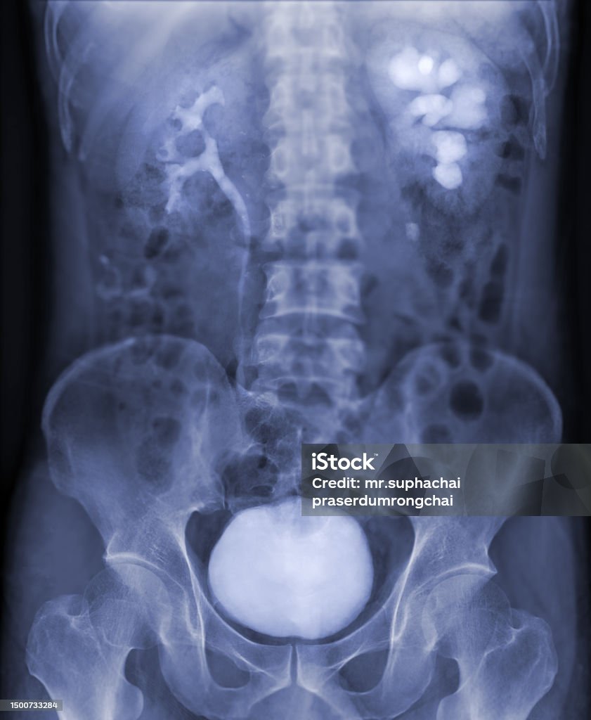 Intravenous Pyelogram Or Ivp Is An Xray Exam Of Urinary Tract After