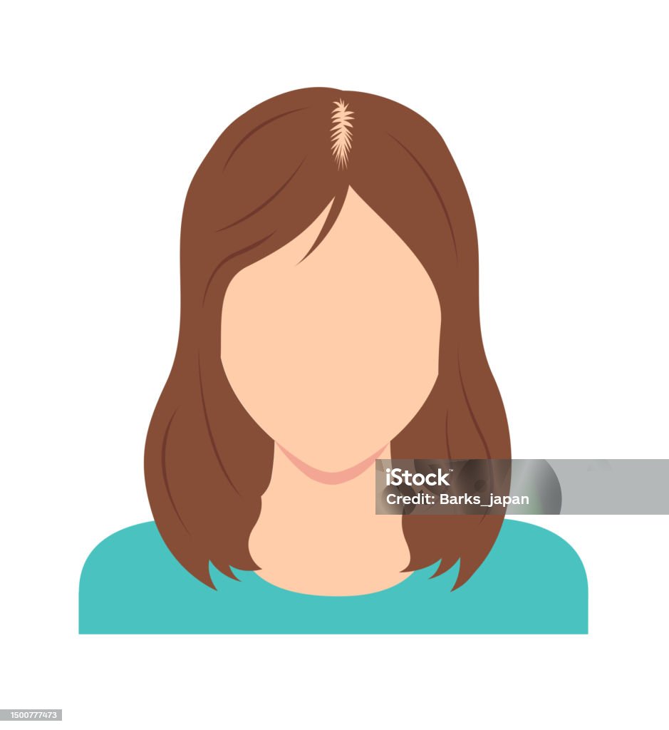 Female Androgenetic Alopecia Vector Illustration Stock Illustration