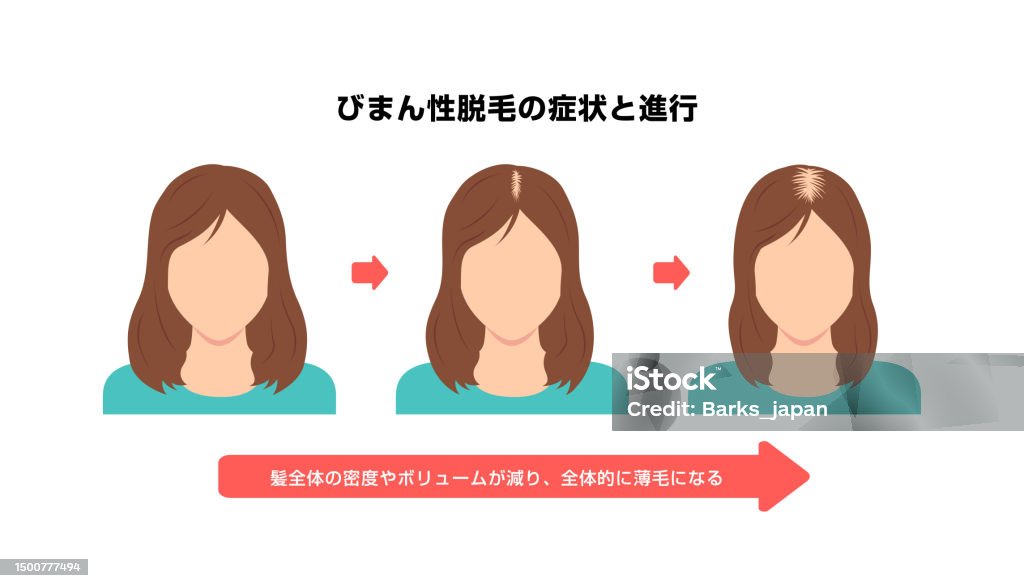 Progress Of Female Androgenetic Alopecia Vector Illustration向量圖形及更多女人圖片