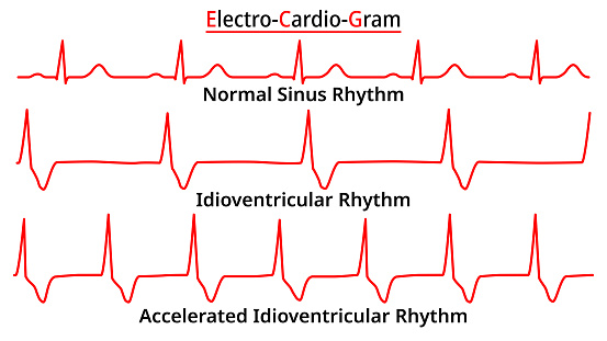 Set Kelainan Umum Ekg Idioventricular Rhythm Vs Accelerated Irama Sinus Normal Ilustrasi Stok