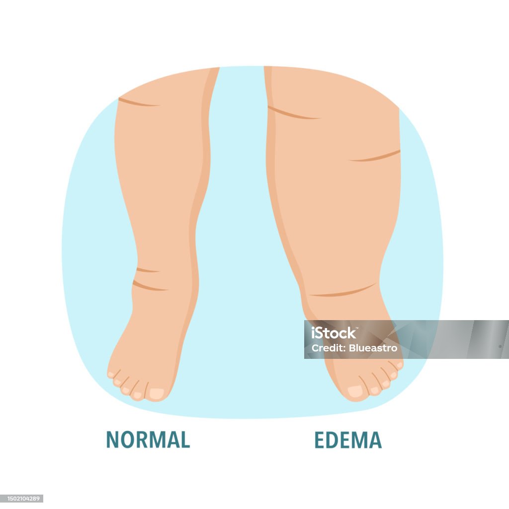 Edema Foot Swollen Leg Disease In Flat Design Stock Illustration ... Edema Foot Swollen Leg Disease In Flat Design Stock Illustration ...