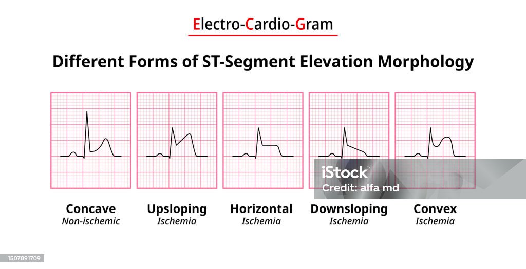 Different Forms Of Stsegment Elevation Morphology Ecg Ischemia Non