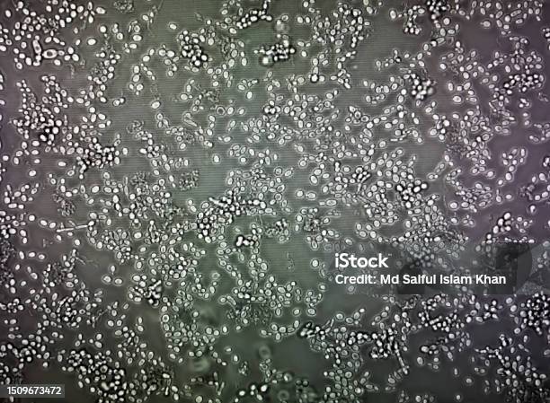 Sel Ragi Tunas Dalam Urin Pasien Pielonefritis Atau Sistitis Dianalisis Dengan Mikroskop Foto