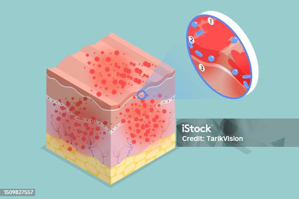 3d Isometric Flat Vector Conceptual Illustration Of Atopic Dermatitis