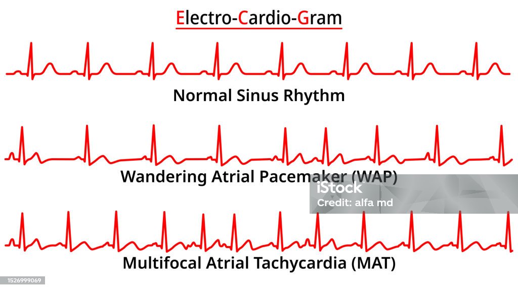 Set Of Ecg Common Abnormalities Wandering Atrial Pacemaker ... Set Of Ecg Common Abnormalities Wandering Atrial Pacemaker ...