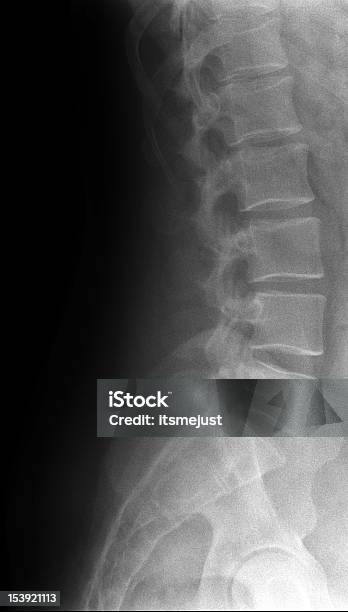 Xray 척추 X 레이에 대한 스톡 사진 및 기타 이미지 X 레이 건강 진단 건강관리와 의술 Istock