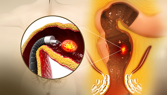 Colon Cancer Colon Polyp Removal Endoscope Inside Colonoscopy For Colon Polyps Search 3d