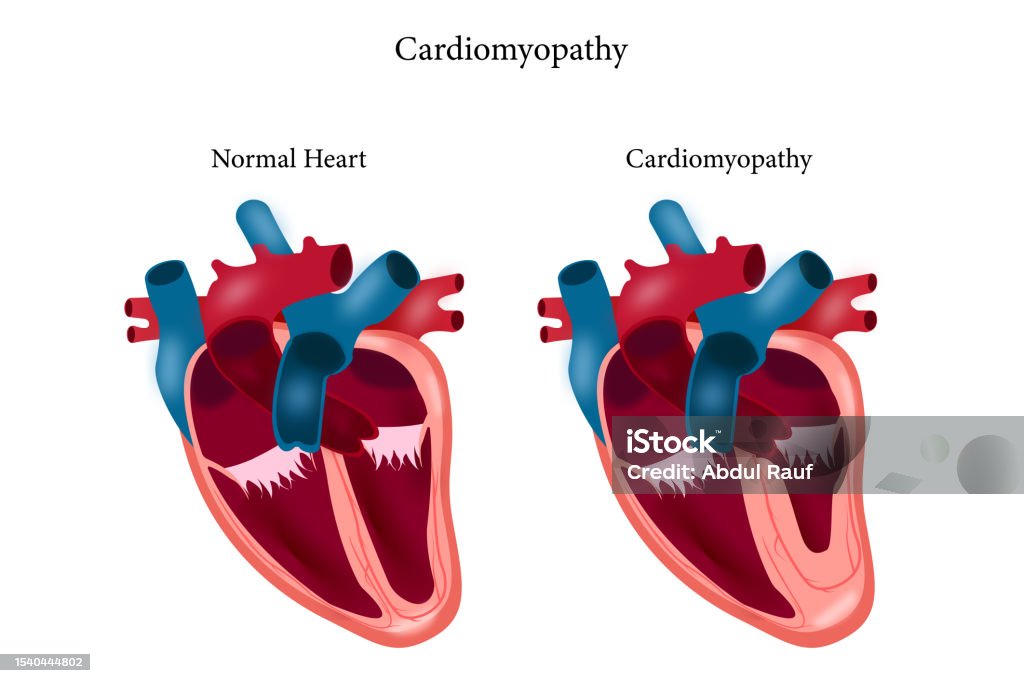 Cardiomyopathy Stock Illustration Download Image Now Cardiomyopathy