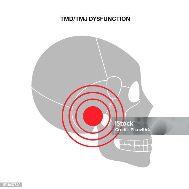 Tmd Tmj Disorder Stock Illustration Download Image Now Anatomy