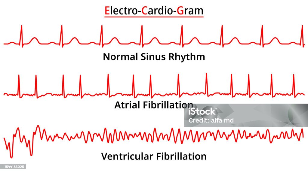 Set Ekg Kelainan Umum Fibrilasi Atrium Fibrilasi Ventrikel Irama Sinus ... Set Ekg Kelainan Umum Fibrilasi Atrium Fibrilasi Ventrikel Irama Sinus ...
