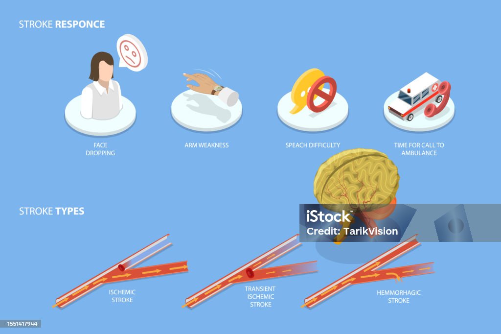 3d Isometric Flat Vector Ilustrasi Konseptual Masalah Suplai Darah Otak