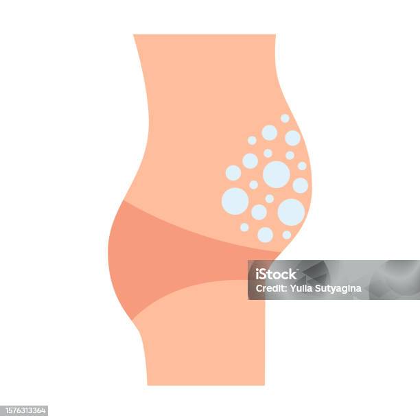 Protruding Belly Of Human With Bloating Flatulence Bubbles In Tummy Irritable Bowel Syndrome Ibs
