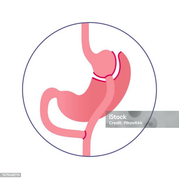 Gastric Bypass Surgery Stock Illustration Download Image Now Gastric Bypass Icon Symbol