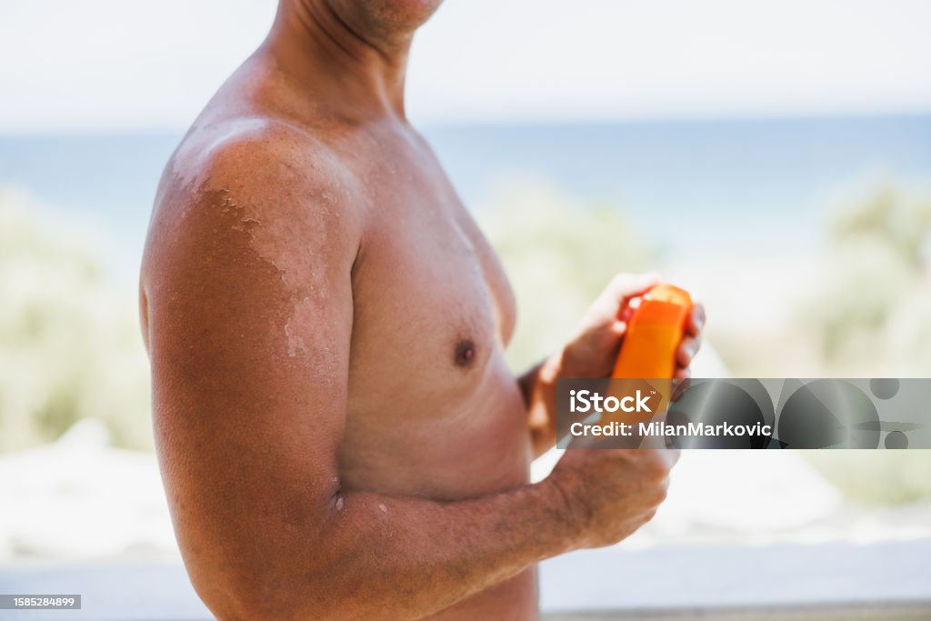 Closeup Of A Red Shoulder And Back Of A Man With A Sunburned Skin Stock