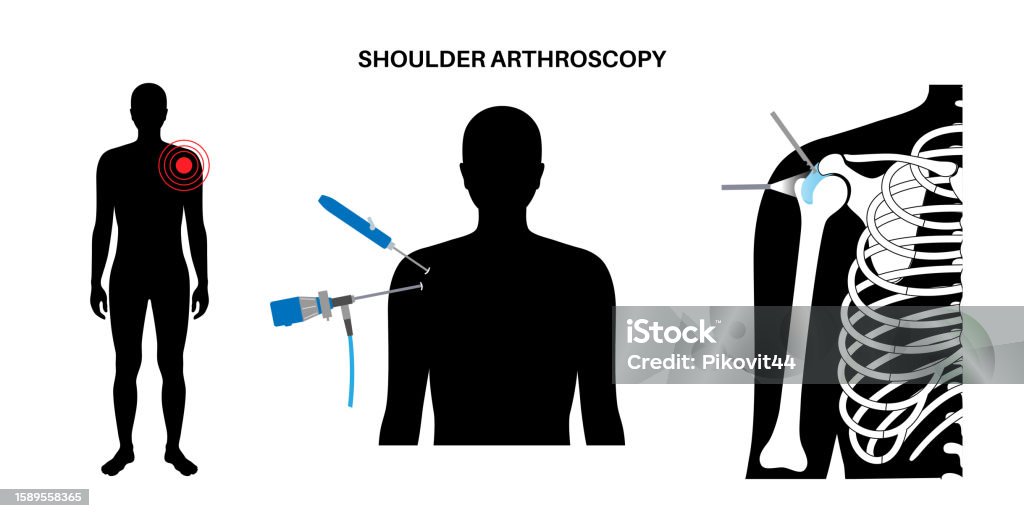 Shoulder Arthroscopy Poster Stock Illustration Download Image Now