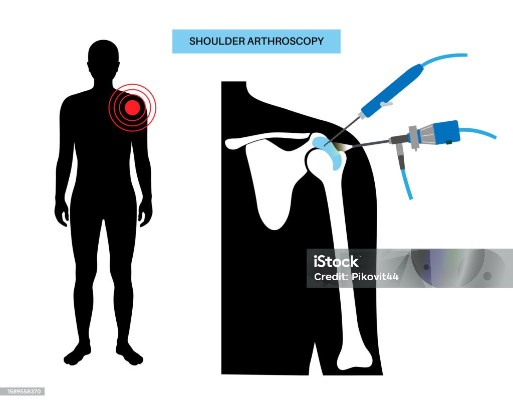 Shoulder Arthroscopy Poster Stock Illustration Download Image Now