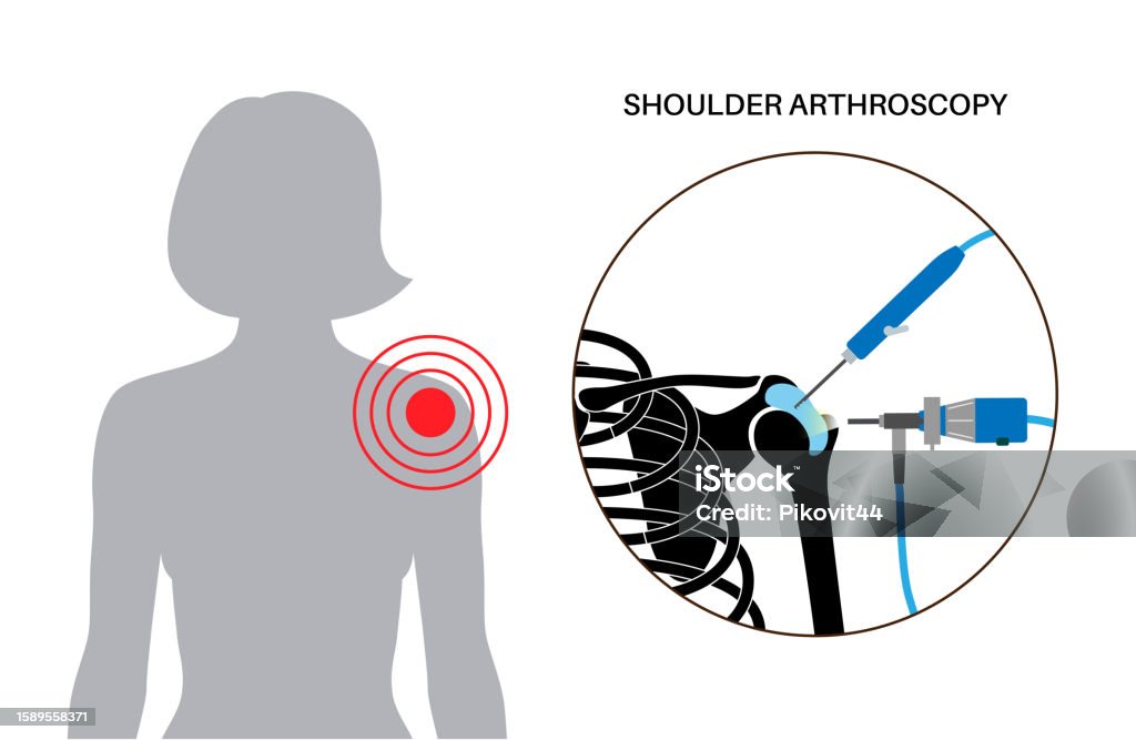 Shoulder Arthroscopy Poster Stock Illustration Download Image Now