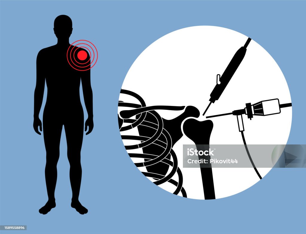 Shoulder Arthroscopy Poster Stock Illustration Download Image Now