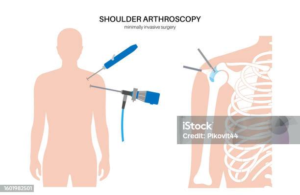 Shoulder Arthroscopy Poster Stock Illustration Download Image Now