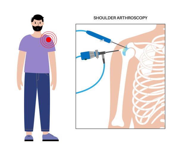 20 Shoulder Arthroplasty Stock Illustrations Royalty Free Vector