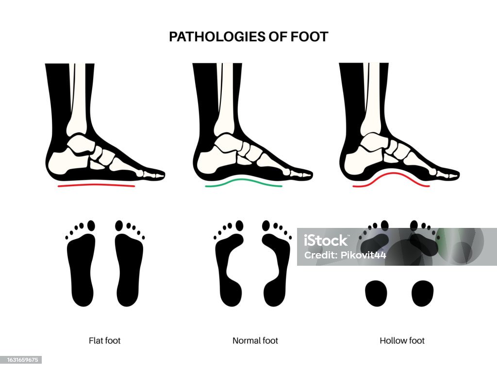 Foot Pathologies Poster Stock Illustration Download Image Now Flat