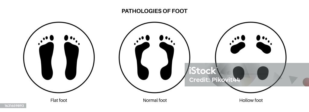Foot Pathologies Poster Stock Illustration Download Image Now Anatomy Fascia Building