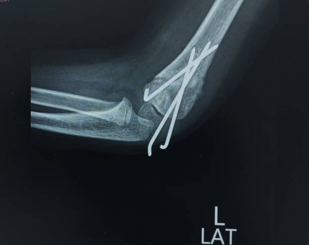 280+ Comminuted Fracture Stock Photos, Pictures & Royalty-Free Images ... 280+ Comminuted Fracture Stock Photos, Pictures & Royalty-Free Images ...