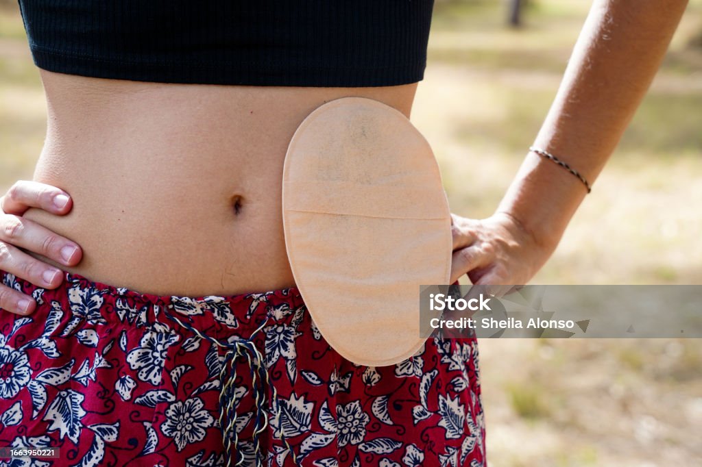 Ostomized Woman Lifestyle With An Ostomy Bag In The Abdomen In Nature Survivor Body Colon Cancer
