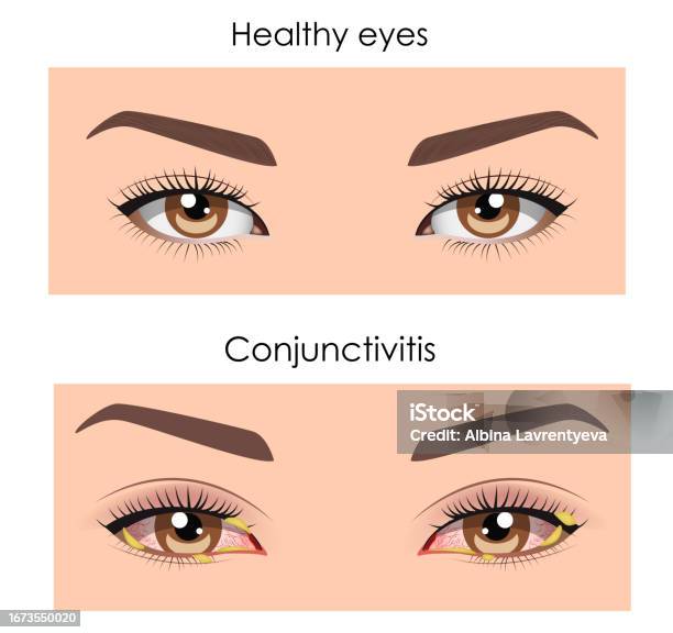 Ilustración De Conjuntivitis Enfermedad Ocular Ilustración De Vector