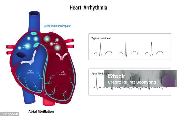 Heart Arrhythmia Vector Cardiac Arrhythmia Atrial Fibrillation An ... Heart Arrhythmia Vector Cardiac Arrhythmia Atrial Fibrillation An ...