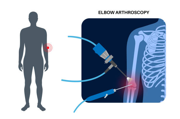 190 Arthroscopic Surgery Stock Illustrations Royalty Free Vector