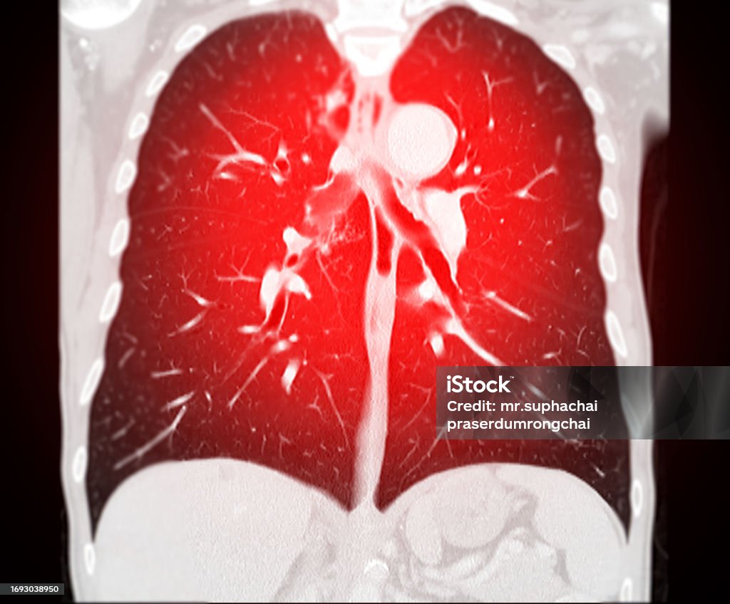 Ct Scan Tampilan Koronal Dada Untuk Diagnostik Emboli Paru Kanker