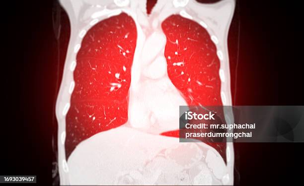Ct Scan Tampilan Koronal Dada Untuk Diagnostik Emboli Paru Kanker