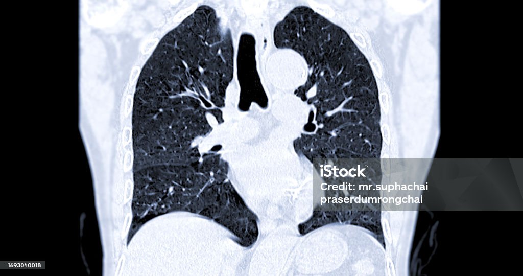 Ct Scan Tampilan Koronal Dada Untuk Diagnostik Emboli Paru Kanker