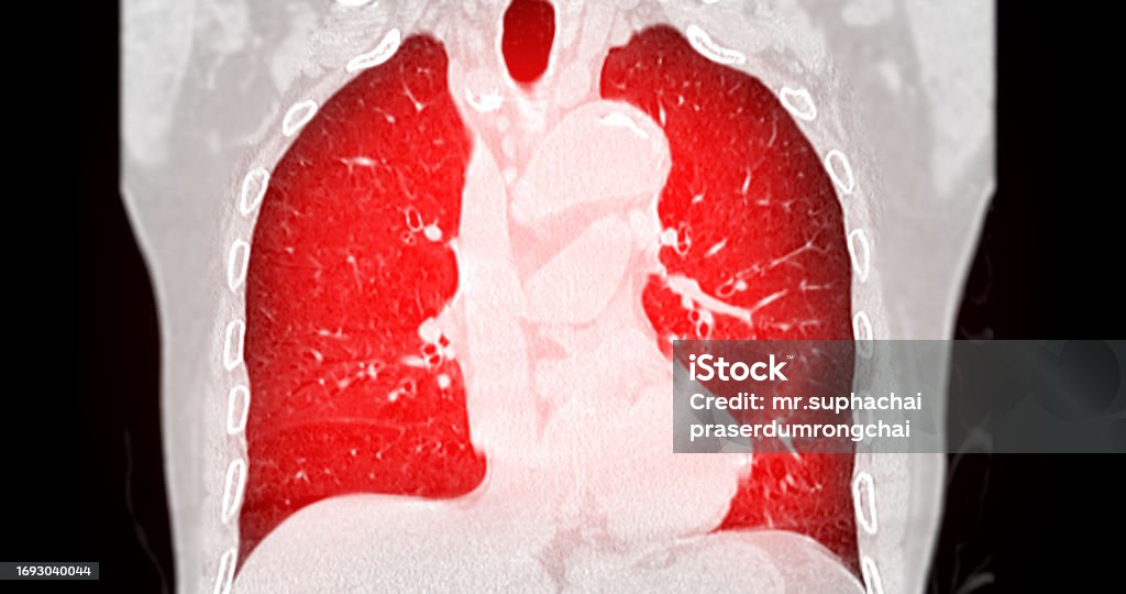 Ct Scan Tampilan Koronal Dada Untuk Diagnostik Emboli Paru Kanker