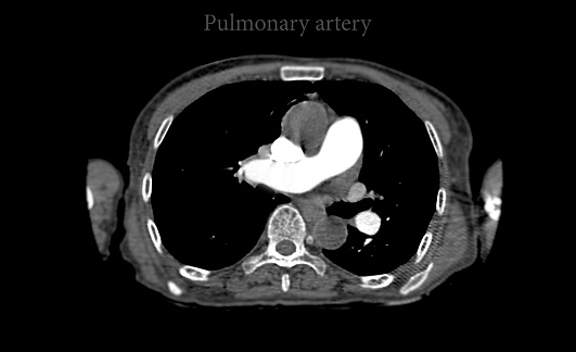 Ctpa Atau Cta Arteri Pulmonalis Untuk Diagnostik Pulmonary Embolism