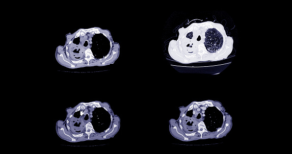 Ctpa Atau Cta Arteri Pulmonalis Untuk Diagnostik Pulmonary Embolism