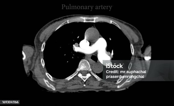 Ctpa Atau Cta Arteri Pulmonalis Untuk Diagnostik Pulmonary Embolism