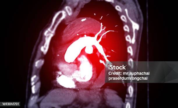 Ctpa Atau Cta Arteri Pulmonalis Untuk Diagnostik Pulmonary Embolism
