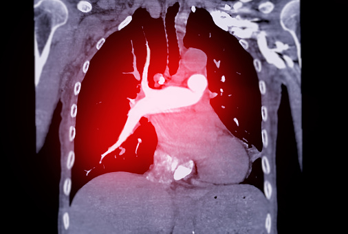 Ctpa Atau Cta Arteri Pulmonalis Untuk Diagnostik Pulmonary Embolism