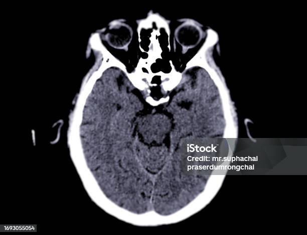 Ct Scan Otak Bidang Aksial Untuk Diagnosis Tumor Otak Penyakit Stroke