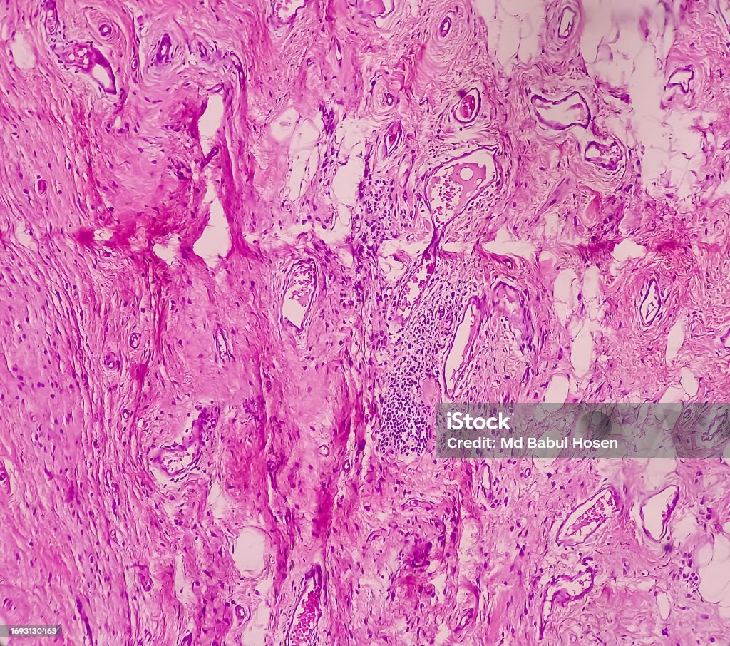 Synovial Tissue Of Knee Joint Bakers Cyst Ganglion Cells Show Microscopic View Cyst Wall