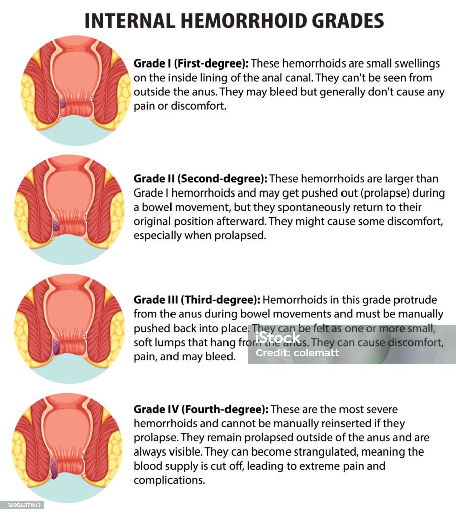 Educational Infographic Internal Hemorrhoid Grades Stock Illustration